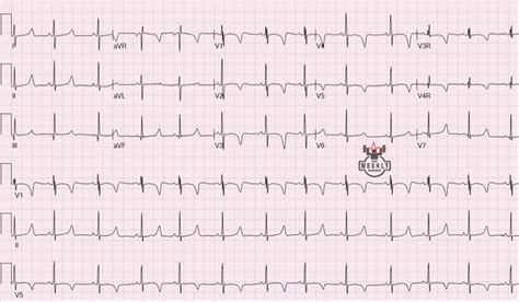 Juvenile T Wave Pattern Ecg Weekly