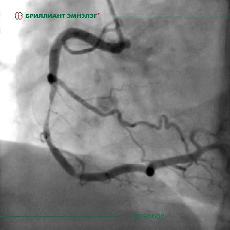 Бриллиант 🫀 Танд дараах шинж тэмдэг зовиур илэрч байна уу 👩‍⚕️ Хүзүү хөших Зүүн гар бадайрах