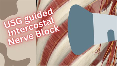 Discover The Benefits Of Usg Guided Intercostal Nerve Block