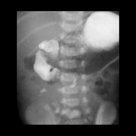 Newborn With Bilious Vomiting Pediatric Radiology Case Pediatric