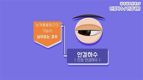 😀 안검하수 안검내반 공주성모안과 내눈바로알기 졸려보이는 눈은 다 안검하수인가요 진짜 안검하수와 가짜 안검하수가 뭔가요 속눈썹말림증 안검내반 은 뭔가요 쌍꺼풀