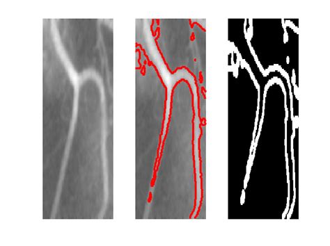 matlab contrast enhancement of an image using neighbourhoood stack overflow