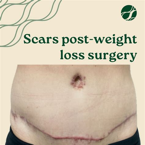 Helen Douglas On Linkedin Scars From Weight Loss Surgery Can Be