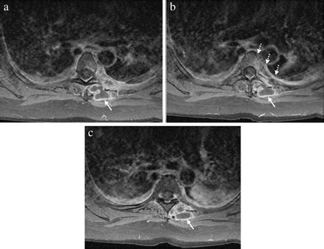 Ac Axial Mri Thoracic Spine T1 Post Contrast Imaging Demonstrating Download Scientific Diagram