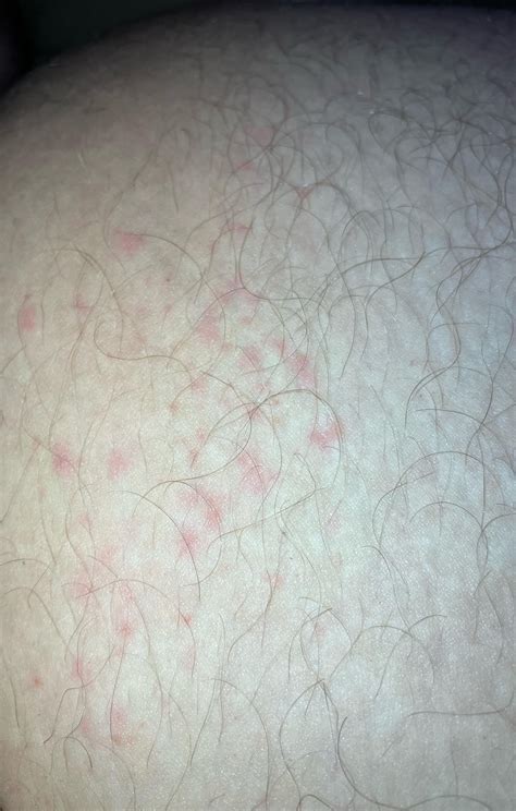 Inner Thigh Rash R Dermatologyquestions
