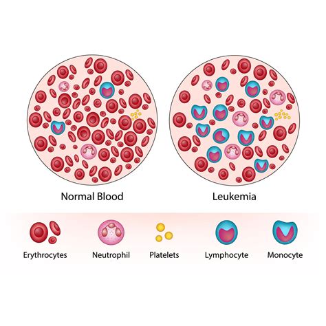 Premium Vector Normal Blood And Leukemia Erythrocytes Neutrophils