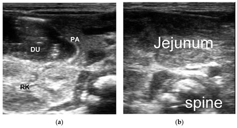 Ultrasonic Diagnosis Of Intestinal Obstruction In Neonates Original Article