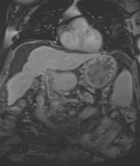 A 60 Year Old Male Who Developed Alcoholic Cirrhosis Presents With