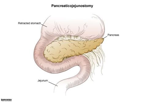 Pancreaticojejunostomy