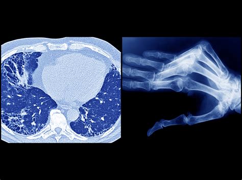 Rheumatoid Arthritis And Interstitial Lung Disease Managing A Complex Comorbidity