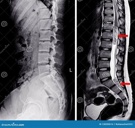Lumbar Spine Anatomy X Ray Normal Spine X Ray And Ct Anatomy Pkwbv