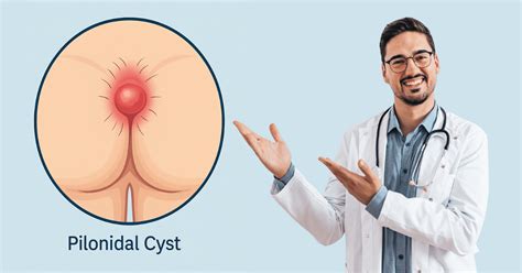 Pilonidal Cyst Causes Symptoms And Effective Treatment