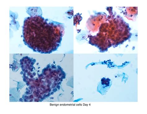 Glandular Lesions Cytology In Cervical Cytology Pdf