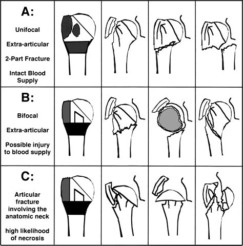 Types Of Humeral Neck Fracture At Lois Lanning Blog
