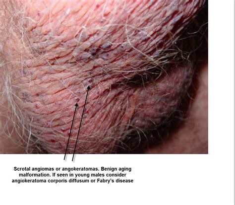 Dermatoscopy Made Simple Haemangioma And Angiokeratoma