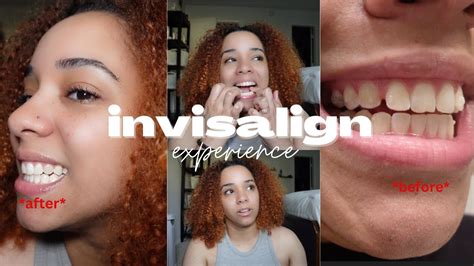 INVISALIGN EXPERIENCE First Hours Before And After Cost Pain Realistic Vlog Style YouTube
