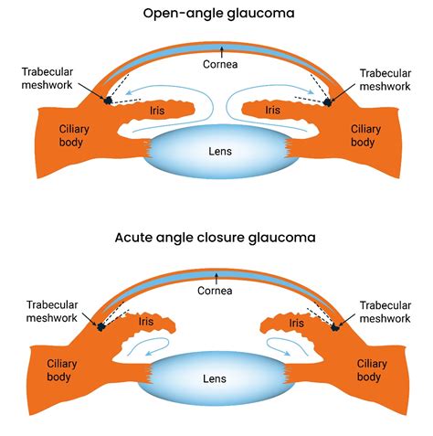 Primary Open Angle Glaucoma And Epinephrine At Gary Manuel Blog