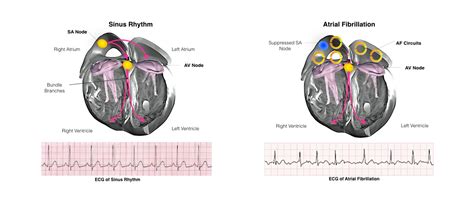 AV Node Ablation One Heart Cardiology