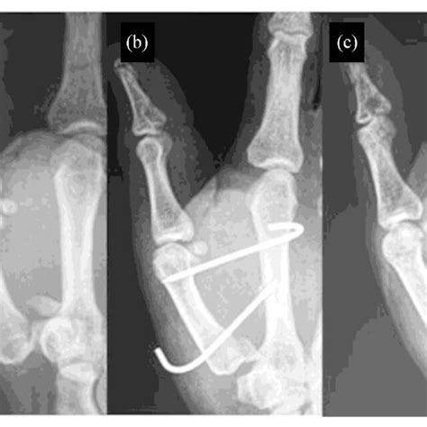 Small Fragment Bennett Fracture Of The Right Thumb A Treated With Download Scientific