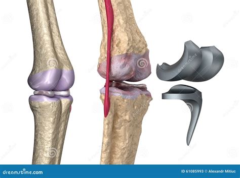 Knee And Titanium Hinge Joint Stock Illustration Illustration Of Ligament Broken 61085993