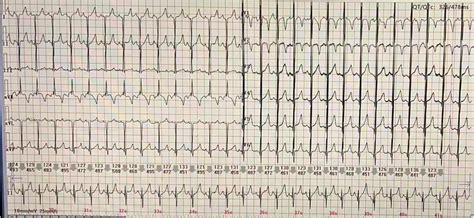 Electrocardiography Reveals A Prolonged Qtc Interval Download Scientific Diagram