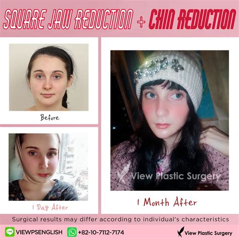 Slimmer And Smaller Face Plastic Surgery Facial Contouring Face Surgery