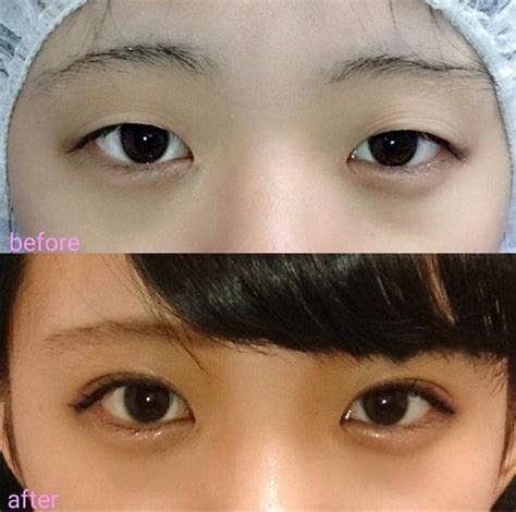 쌍수하면 눈썹 눈 사이 가까워져 인스티즈instiz 뷰티 카테고리