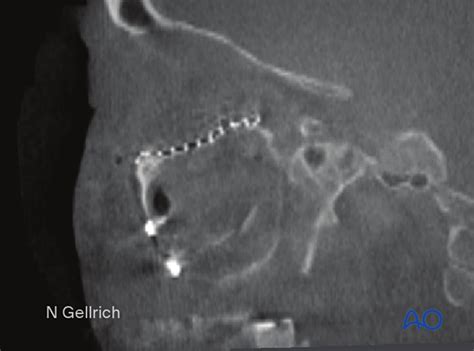 Orif 4 Point Fixation With Orbital Reconstruction For Zygoma