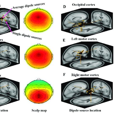 Eeg Dipole Source Location And Scalp Map Of Six Clusters Including A