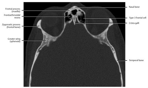 Cross Sectional Computed Tomography And Magnetic Resonance Imaging