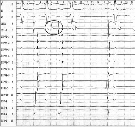 Electrophysiological Characteristics Of Atrial Tachycardia Originating