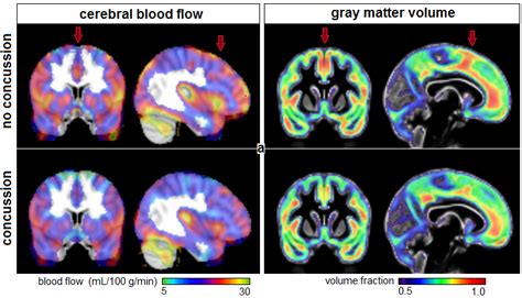 Concussion Brain Compared To Normal