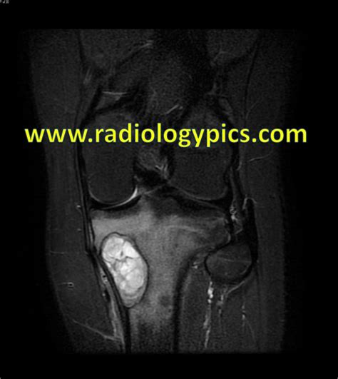 Unknown Case 16 Lytic Lesion In The Tibia What Is Your Differential Diagnosis Share It Here