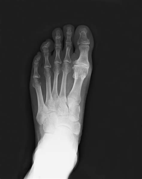 Hallux Limitus Rigidus Cornwall Medical Group
