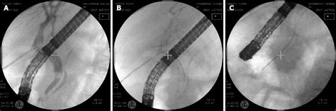 [pdf] A Modified Rendezvous Ercp Technique In Duodenal Diverticulum Semantic Scholar