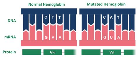 Point Mutation Sickle Cell Anemia