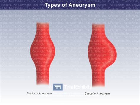 Types Of Aneurysm Trialquest Inc