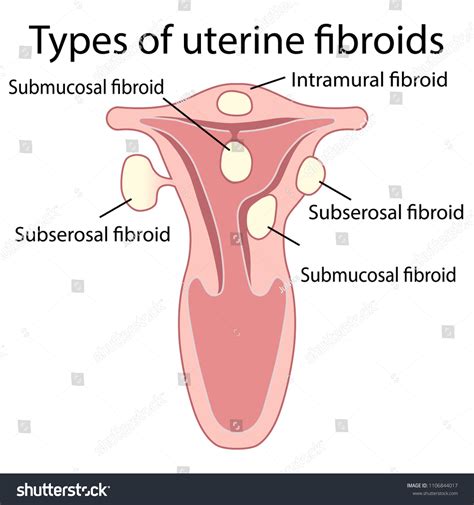 Types Uterine Fibroidsfemale Reproductive Organ Pathology Stock Vector Royalty Free 1106844017
