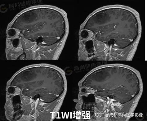 【高尚病例】低级别胶质瘤1例 知乎