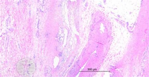 Eosinophilic Fasciitis Pathology Image