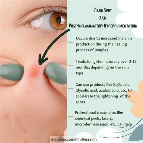 How To Remove Dark Spots Caused By Pimples Dermatologist Explains