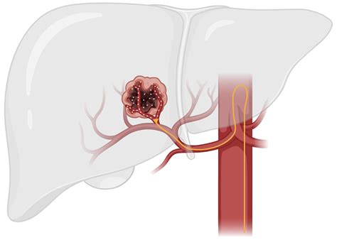 Transarterial Chemoembolization Treatment Paradigms For Hepatocellular Carcinoma