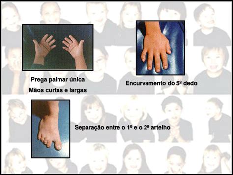 Prega Simiesca Síndrome De Down Librain