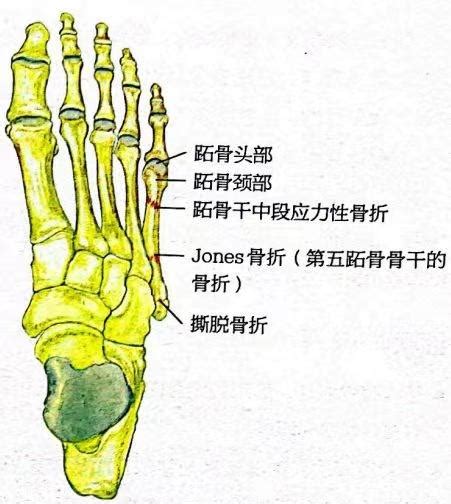 深圳跳绳培训：跖骨骨折 知乎