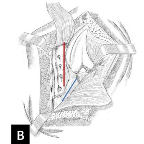 Pdf Sacral Osteotomy Combined With Triangular Osteosynthesis In The