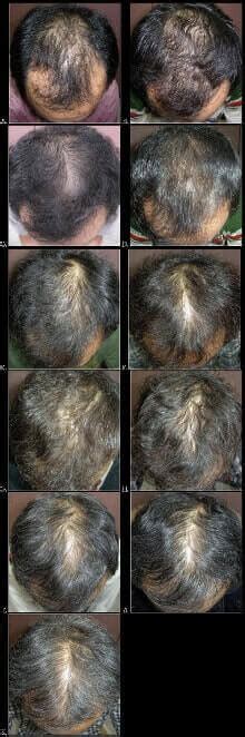 Does Finasteride Work After 20 Years Hair Loss Cure 2020