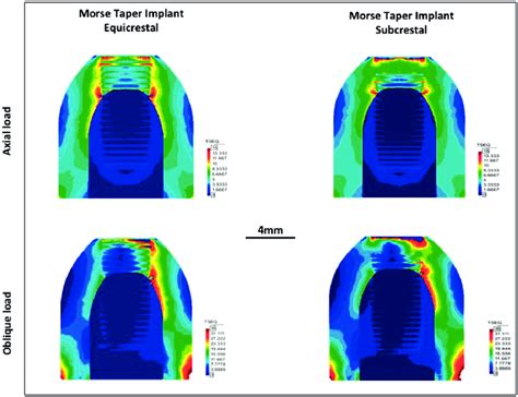 Von Mises Stress Distribution Within The Peri Implant Bone For The