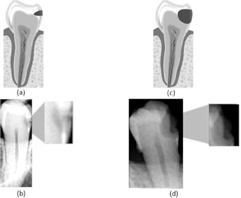Figure 1 From Classification Of Approximal Caries In Bitewing Radiographs Using Convolutional