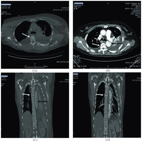 A Forty Nine Year Old Female Who Was Involved In A Chest Compression
