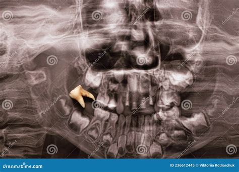 A Panoramic Image Shows Several Embedded And Impacted Teeth As On The